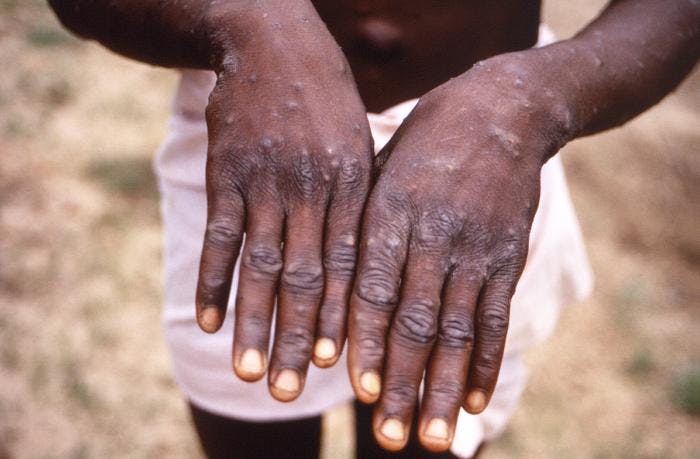 DOH: Philippines Ready For Entry Of Monkeypox | OneNews.PH